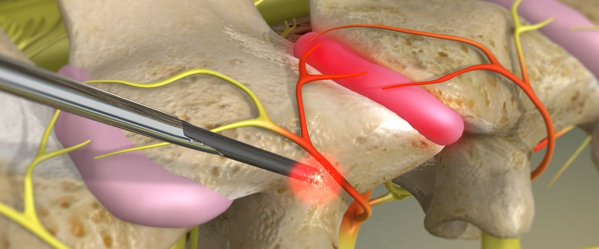 How Long Does a Facet Joint Nerve Block Last?