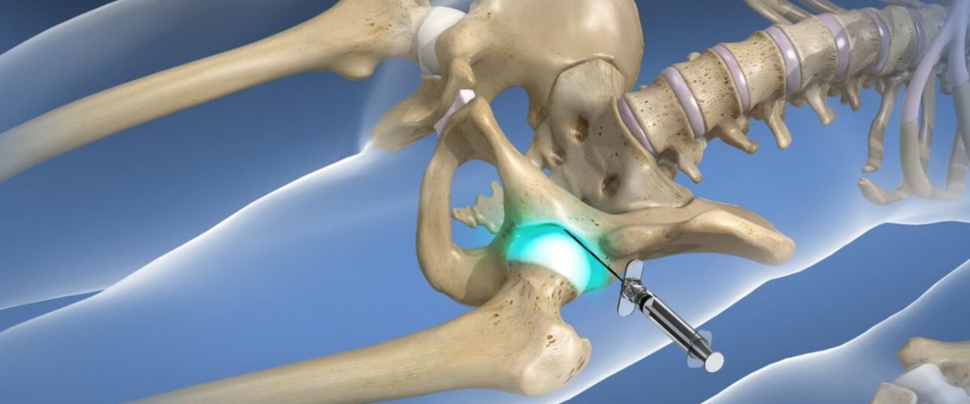 Can I Walk After Facet Joint Injections?